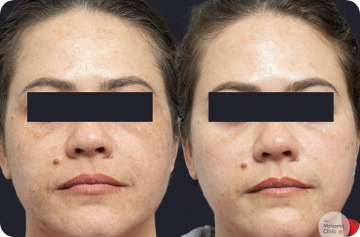 Hyperpigmentation Around Mouth: Causes & Best Treatments