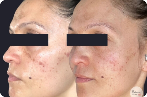 Hyperpigmentation Around Mouth: Causes & Best Treatments