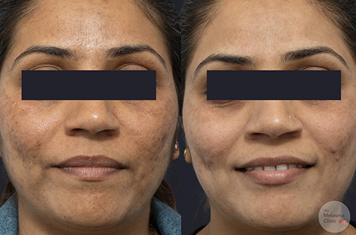 Australia's Best Melasma Treatments | The Melasma Clinic