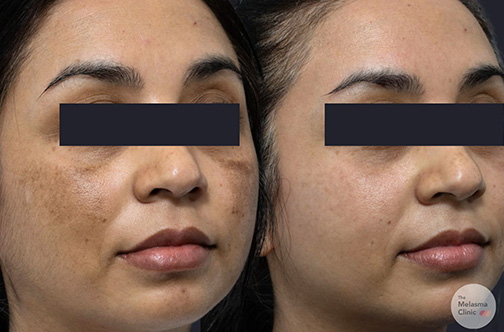 Australia's Best Melasma Treatments | The Melasma Clinic