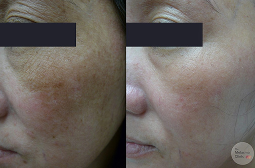 #1 Best Post-Inflammatory Hyperpigmentation (PIH) Treatments