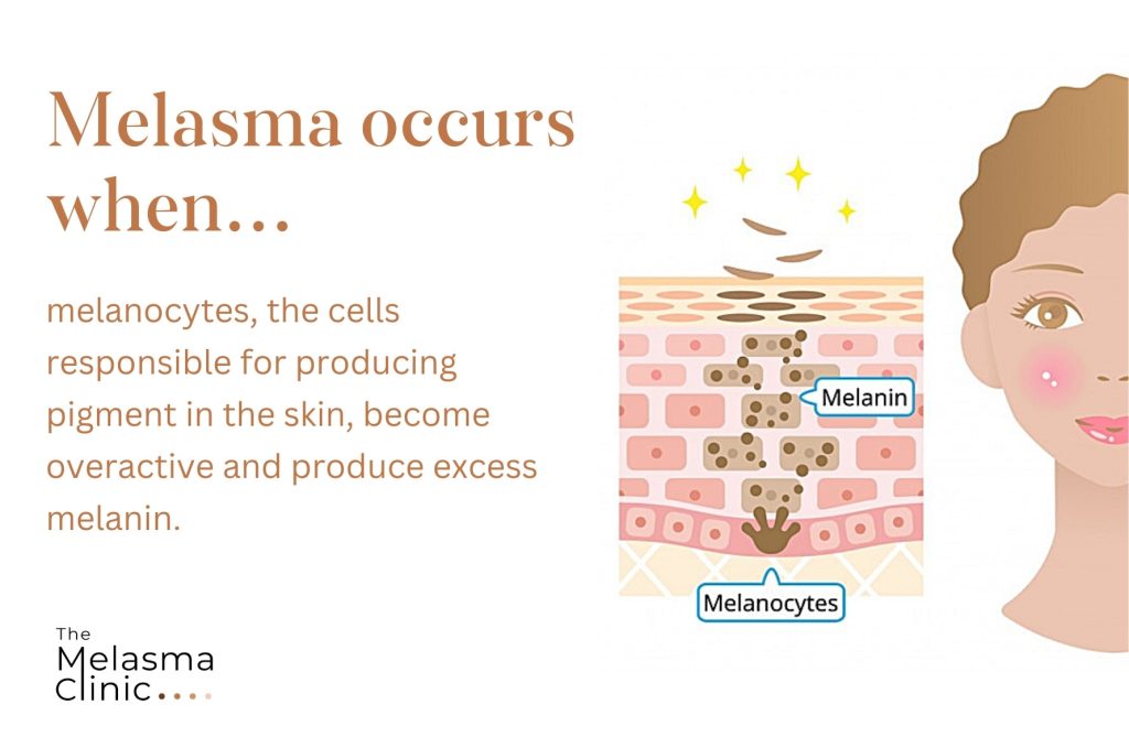 How To Safely Treat Melasma During Pregnancy? | Melasma Clinic