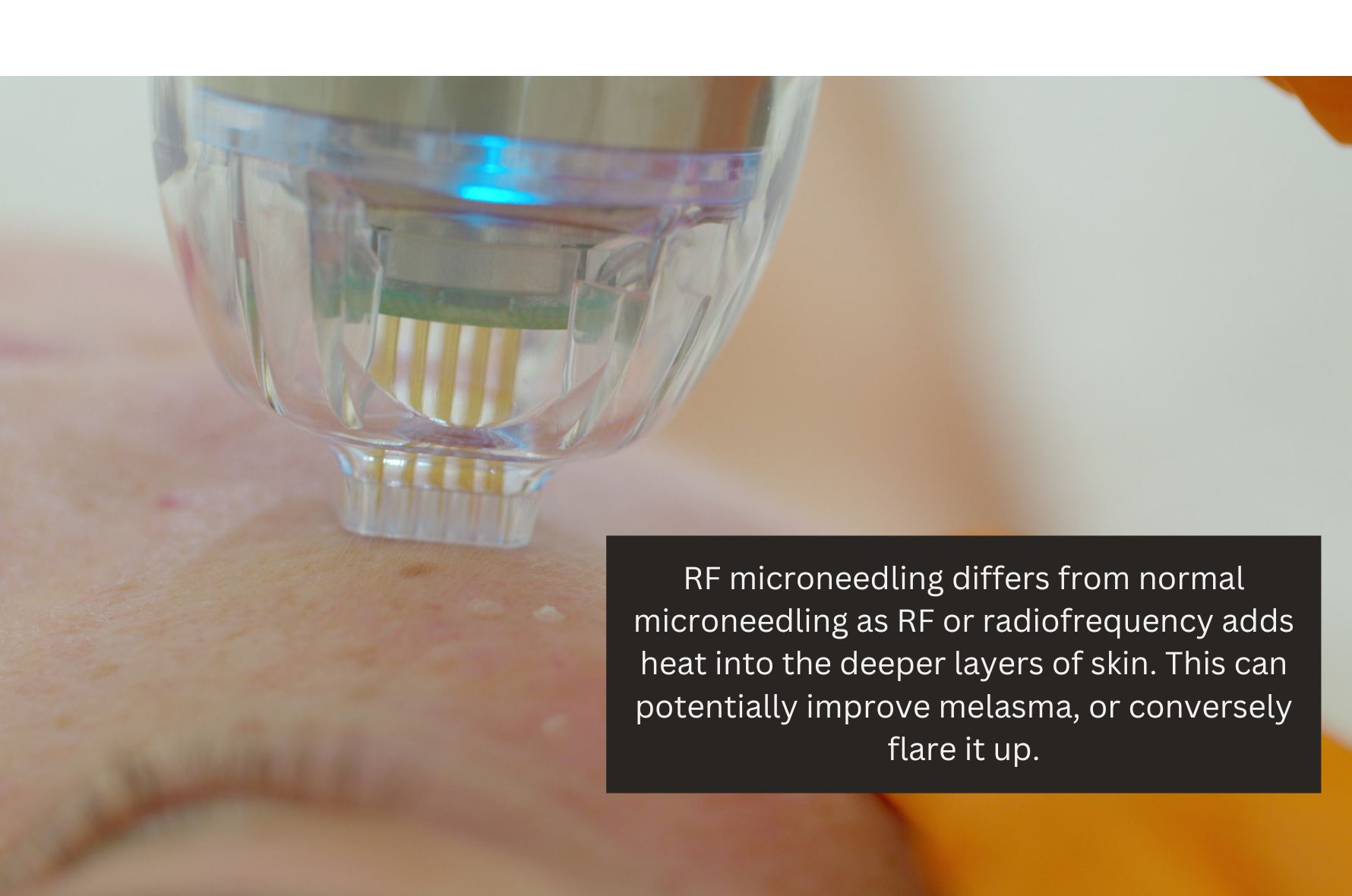 Best Microneedling For Melasma In Brisbane & Sydney Areas