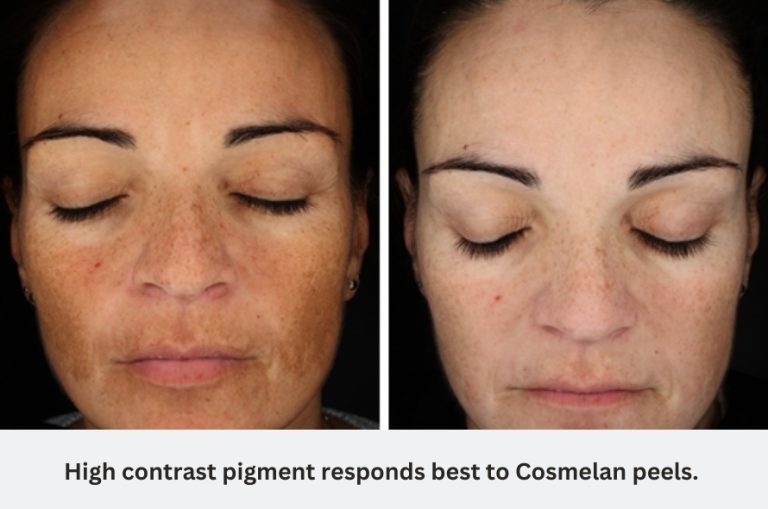 5 Reasons NOT To Cosmelan Peel - The Melasma Clinic