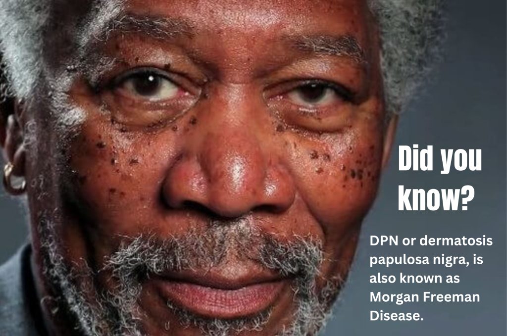 Australia's Best Dermatosis Papulosa Nigra DPN Treatments | The Melasma ...