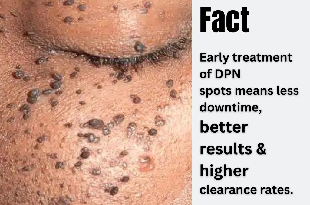 Australia's Best Dermatosis Papulosa Nigra DPN Treatments | The Melasma ...