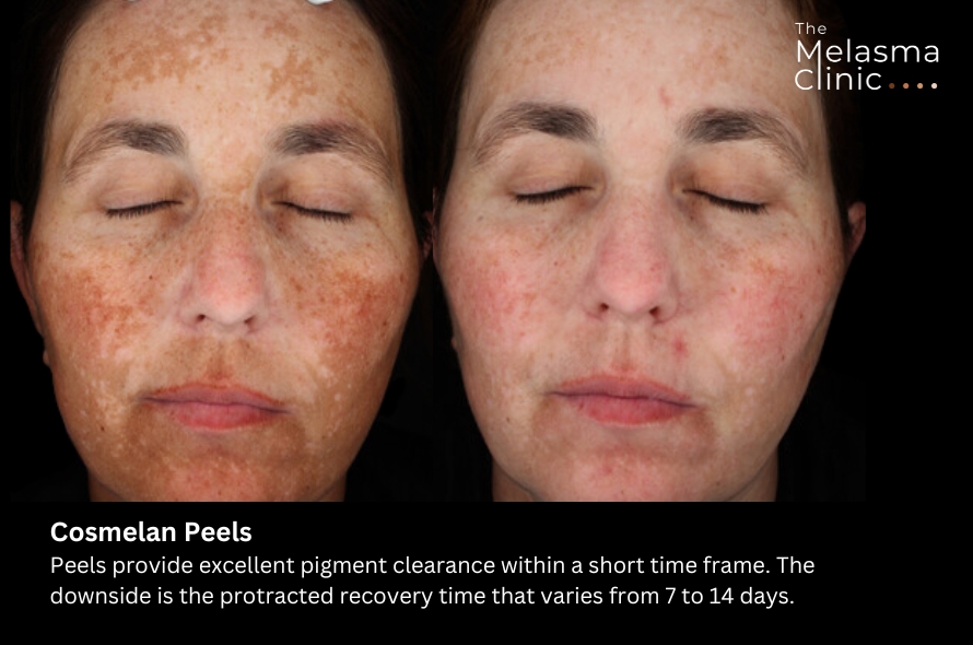 Cosmelan Peel Vs Picosure Laser For Melasma - The Melasma Clinic