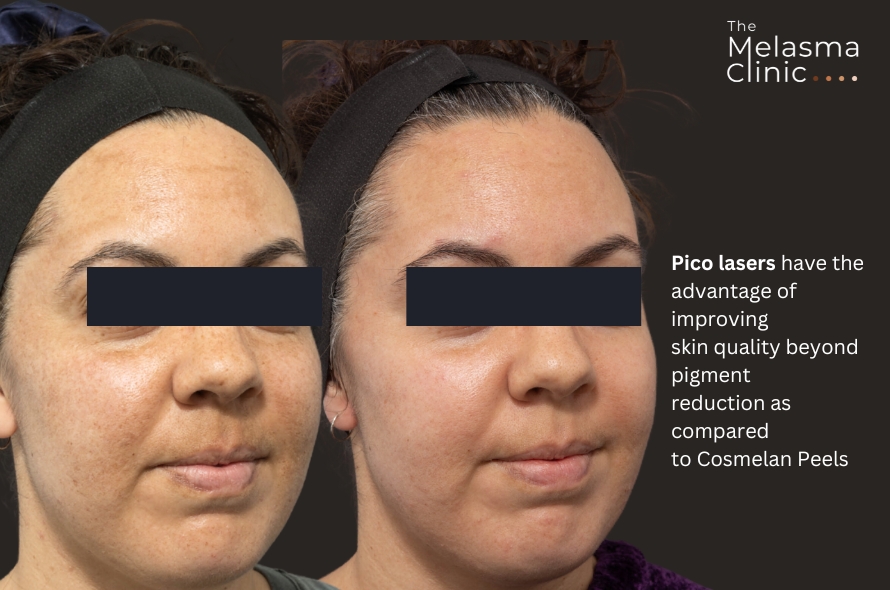 Cosmelan Peel Vs Picosure Laser For Melasma - The Melasma Clinic