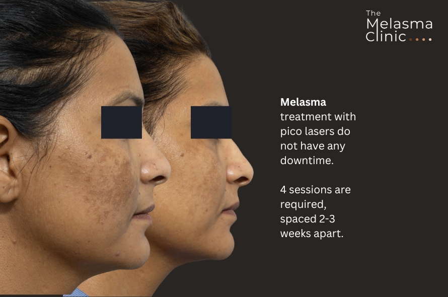 Cosmelan Peel Vs Picosure Laser For Melasma - The Melasma Clinic