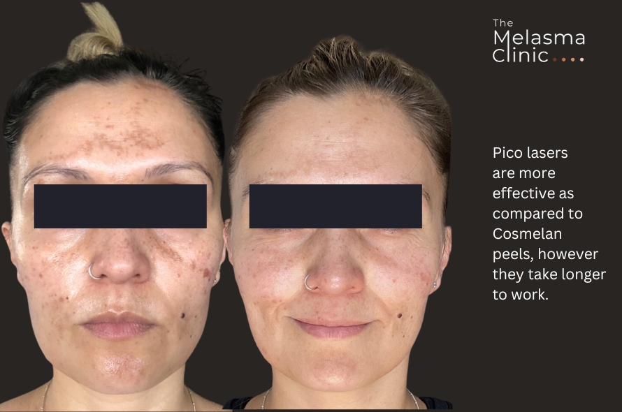 Cosmelan Peel Vs Picosure Laser For Melasma - The Melasma Clinic