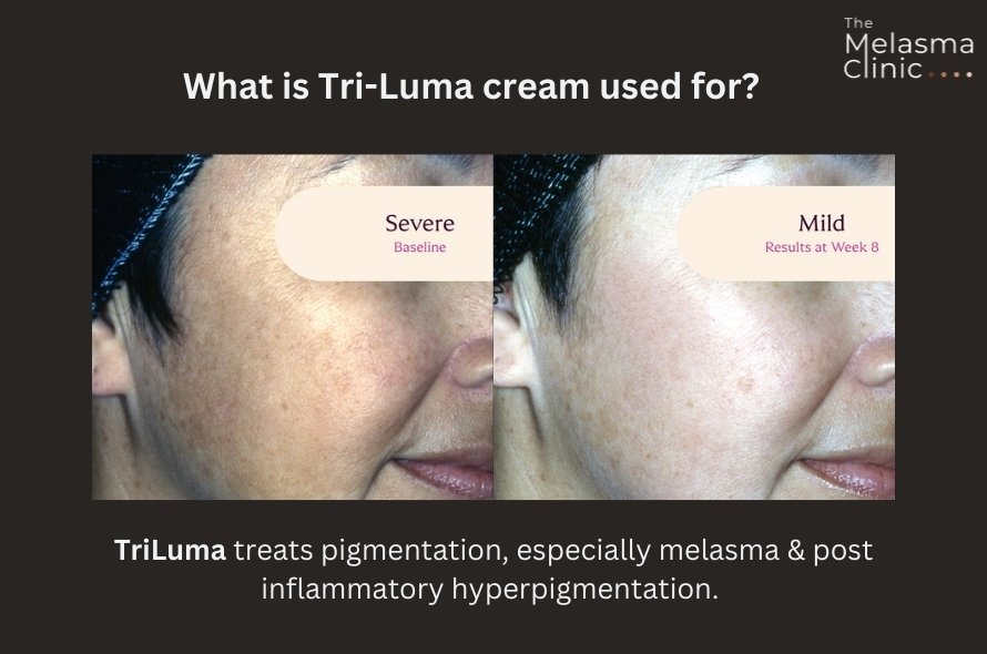 Tri-Luma Cream: Effective Melasma Treatment | Melasma Clinic