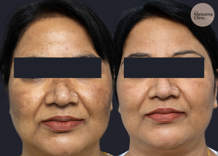 #1 Best Dermal Melasma Treatment - The Melasma Clinic