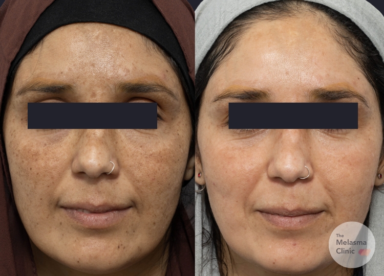 Australia's Best Lasers For Melasma | The Melasma Clinic