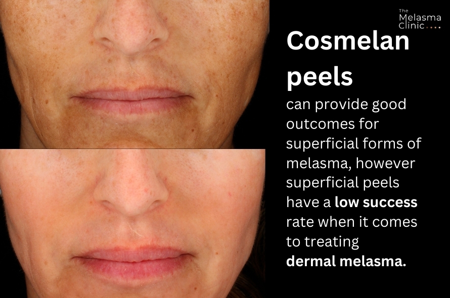 Australia's Best Melasma Treatments | The Melasma Clinic