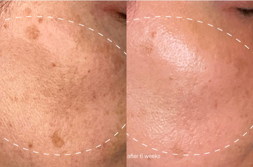 Dermalogica Melanopro Peel For Melasma