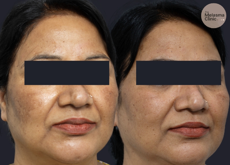 Australia's Best Lasers For Melasma | The Melasma Clinic