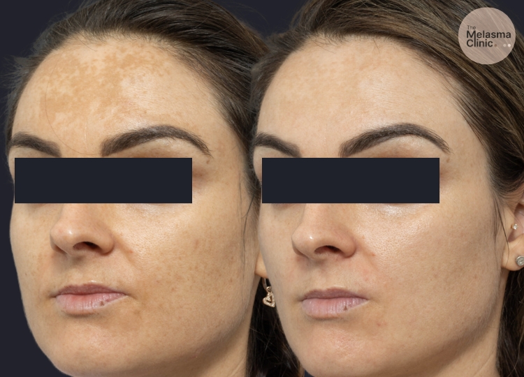 Australia's Best Lasers For Melasma | The Melasma Clinic