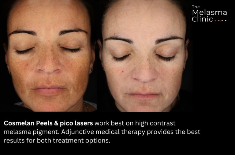 Australia's Best Melasma Treatments | The Melasma Clinic