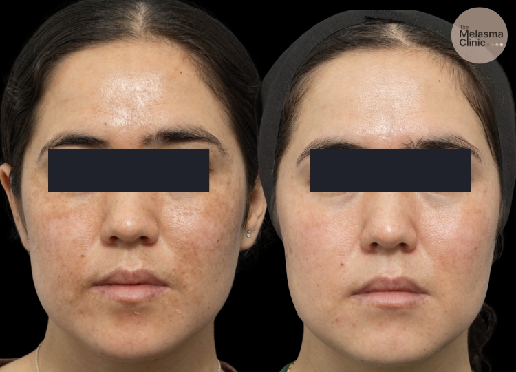 Australia's Best Lasers For Melasma | The Melasma Clinic