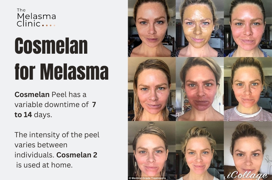 Cosmelan 2 For Melasma Treatment In Brisbane & Sydney