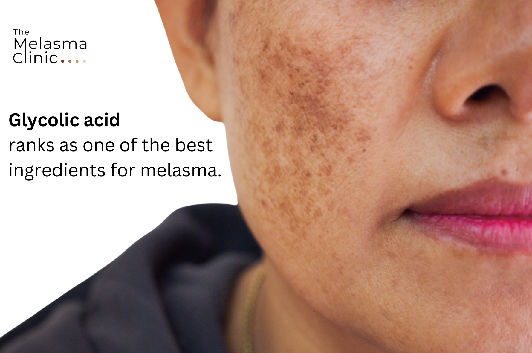 Glycolic Acid For Glowing Skin | Melasma Clinic Australia