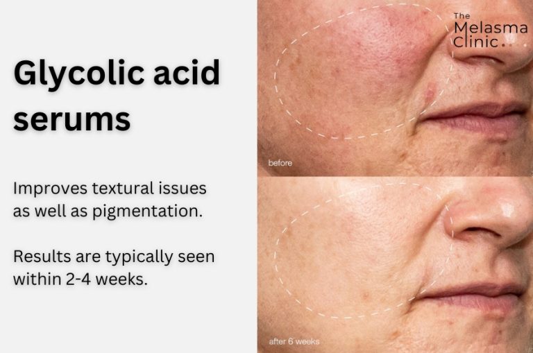 Glycolic Acid For Glowing Skin | Melasma Clinic Australia