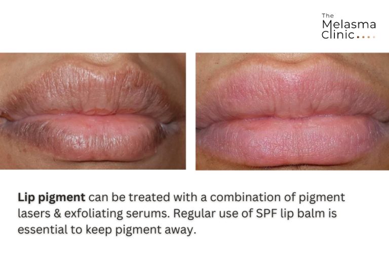 Best Lip Pigmentation Treatment 2026