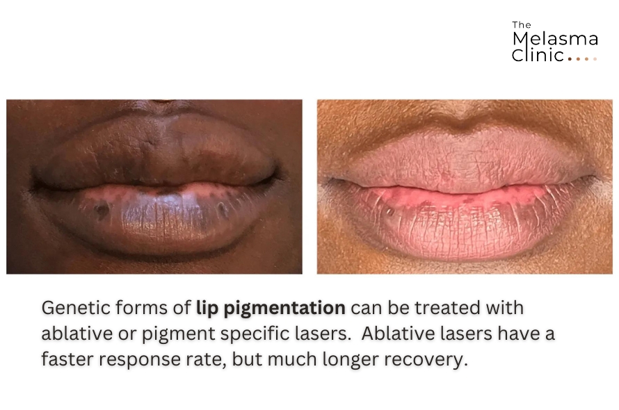 Best Lip Pigmentation Treatment 2025
