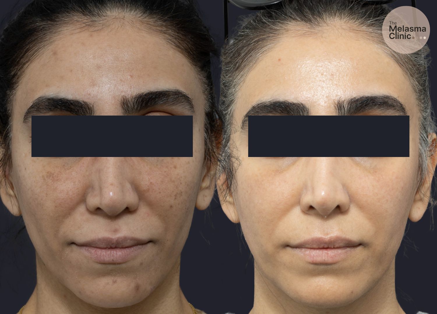 #1 Skin Lightening Clinic In Sydney - The Melasma Clinic